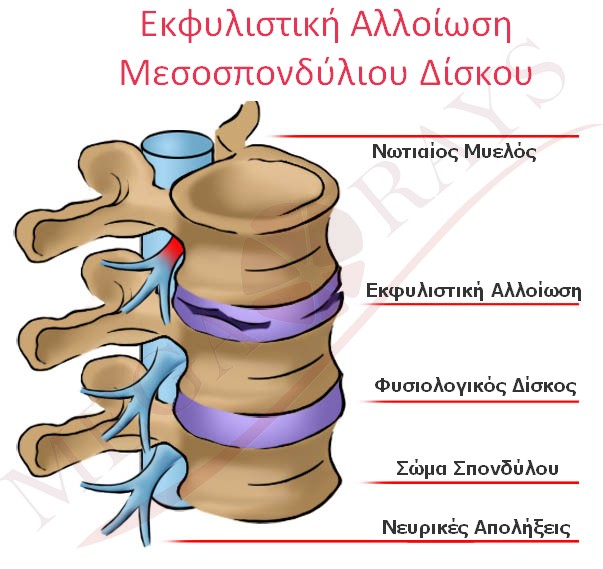 Τι Είναι Η Δισκοπάθεια; Πως Θεραπεύεται; Αυχενικό Σύνδρομο! ⋆ MEGA RAYS